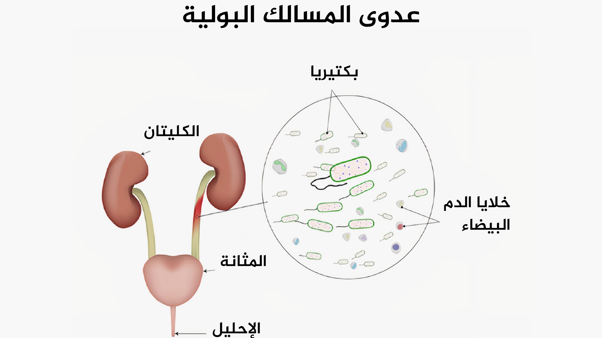 تجربتي مع بكتيريا البول وطرق علاج هذا المرض، وأسباب التهاب المساك البولية - 2trend